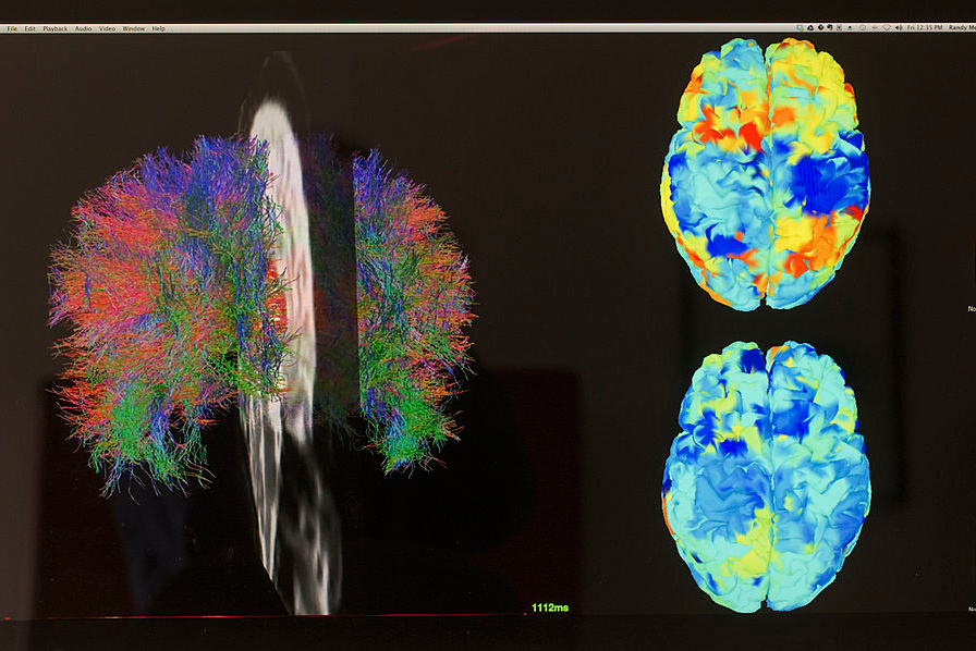 脳に関する研究結果に誤りの可能性？ fMRIのソフトウェアにバグを発見 ─欠陥はすでに修正も残る不安 | Forbes JAPAN 公式サイト ...